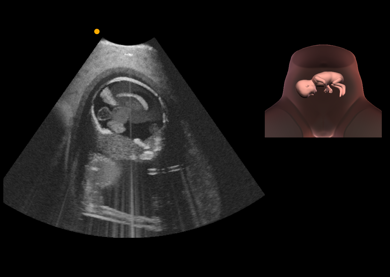 VirtaMed's Obstetric Ultrasound simulator at the EUROSON Congress in ...